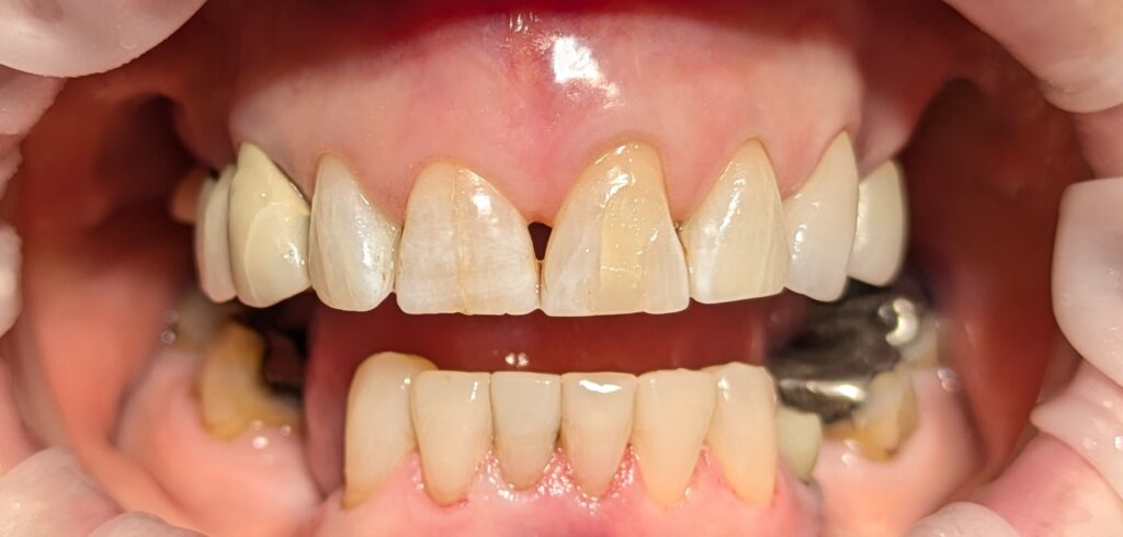 Restoration of worn teeth with injection moulding - Morris Dental ...