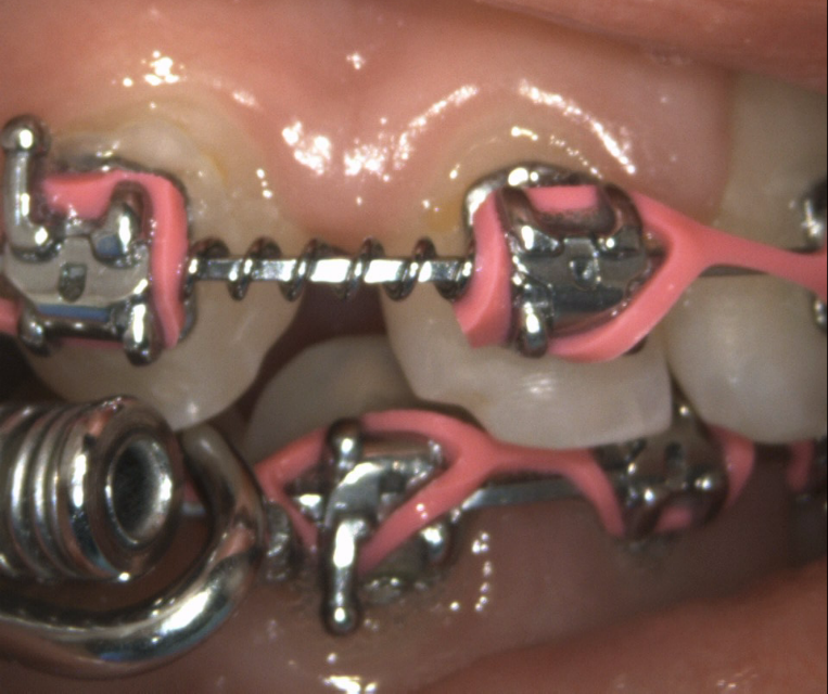 Space closure following orthodontic treatment - Morris Dental : Family ...